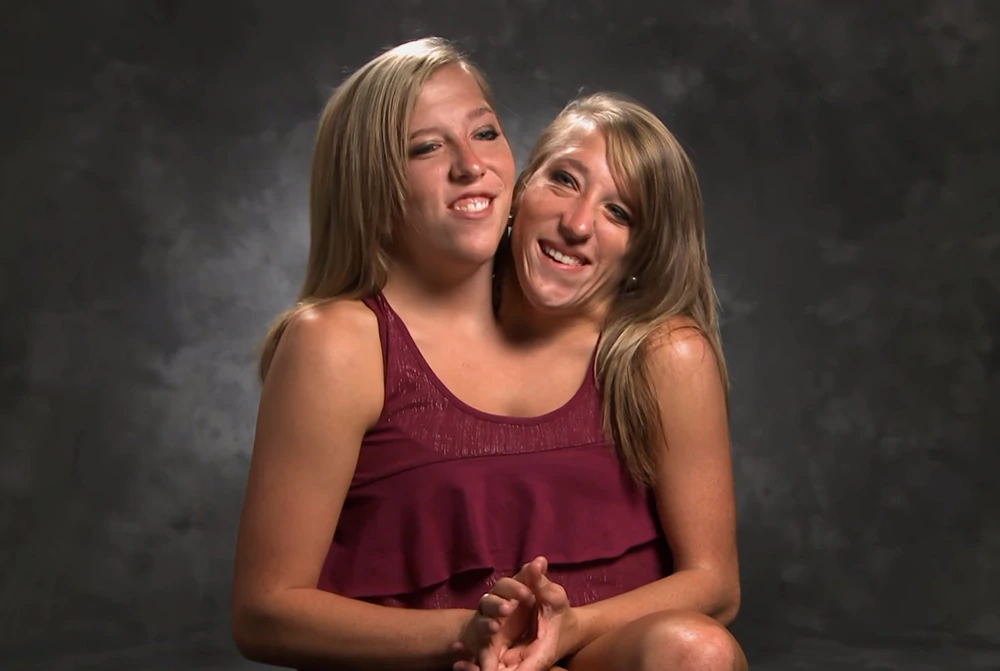 One Of The Ultra-Rare Conjoined Twins Got Married, And The Internet 'Is ...